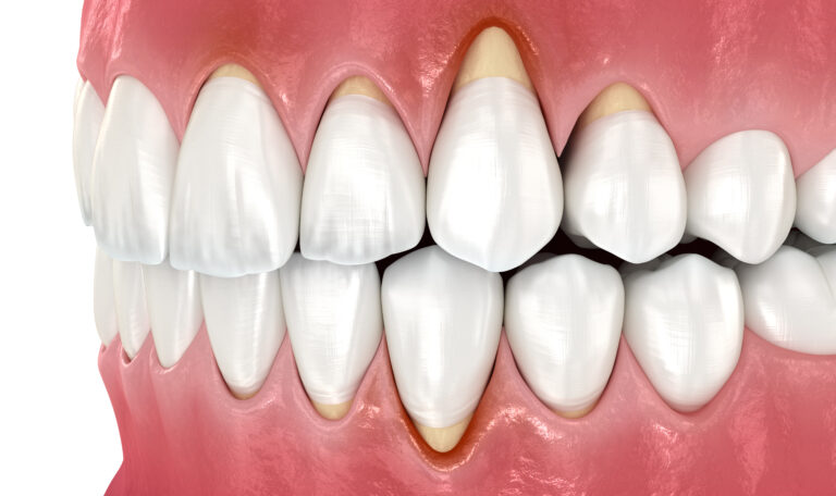Alloderm | Edelweiss Dental Implants