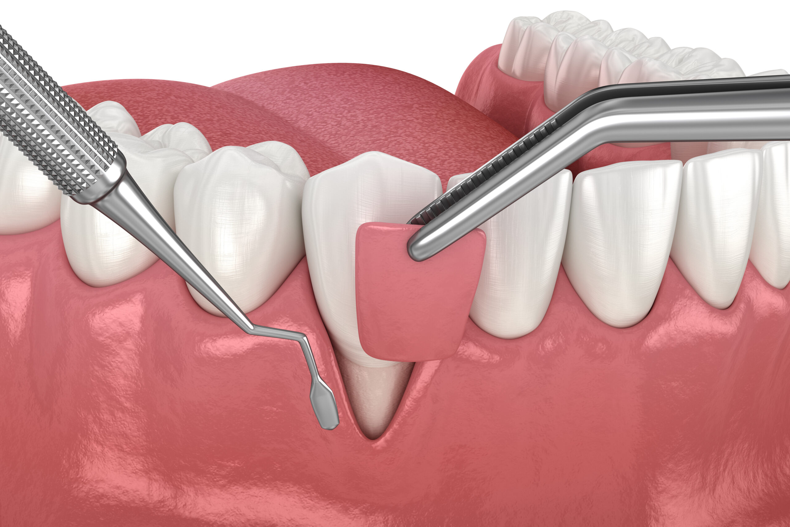Connective Tissue Graft | Edelweiss Dental Implants